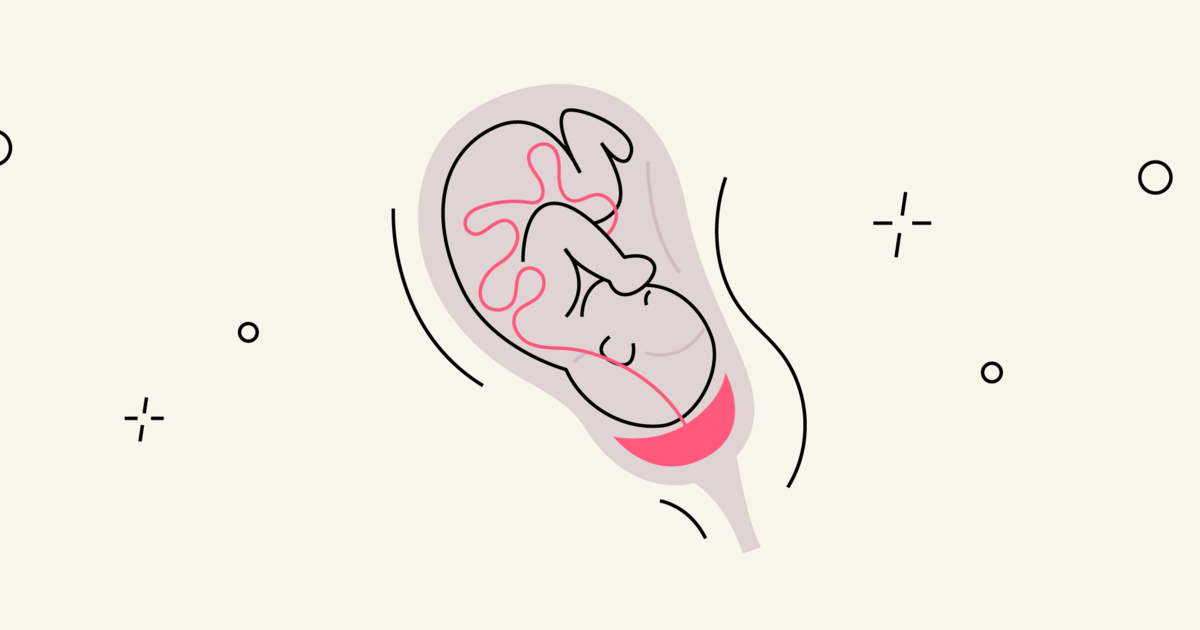 Placenta Previa: Root Causes, Symptoms, and Treatments Placenta Previa: Root Causes, Symptoms, and Treatments